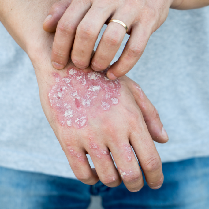 Psoriasis Main [Traitement] Comprendre les Causes & Symptômes - DEXERYL